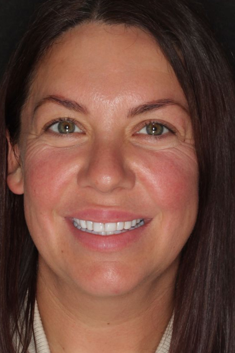 Dental Smile Gallery - LUME Dental in Wilmslow