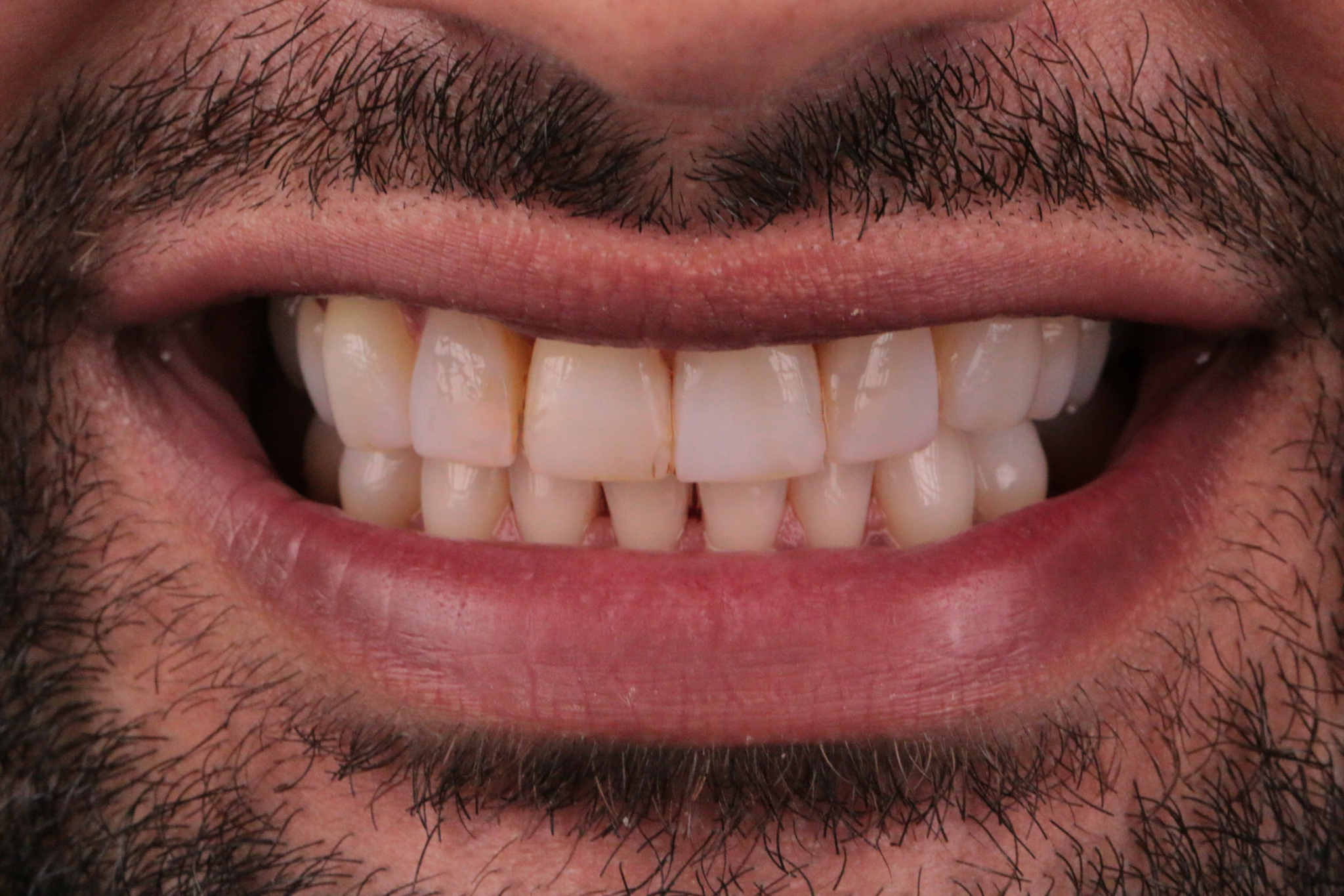 Dental Smile Gallery - LUME Dental in Wilmslow
