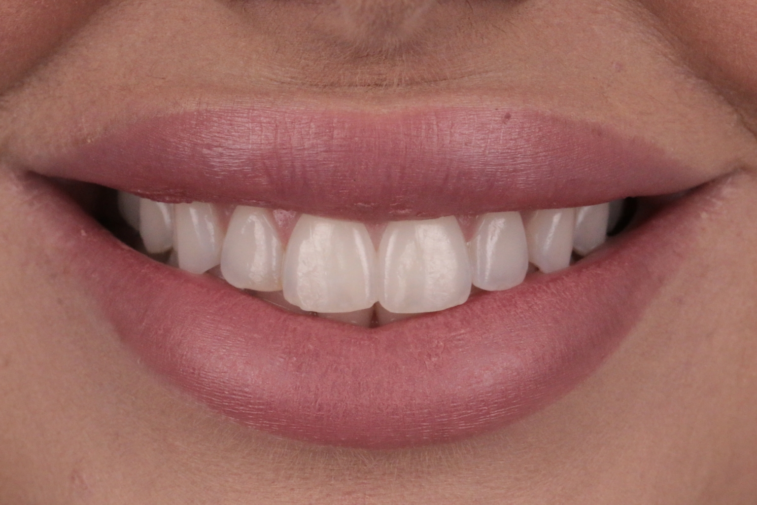 Dental Smile Gallery - LUME Dental in Wilmslow